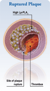 Lp-PLA2 (PLAC®) test for Chemistry Analyzers