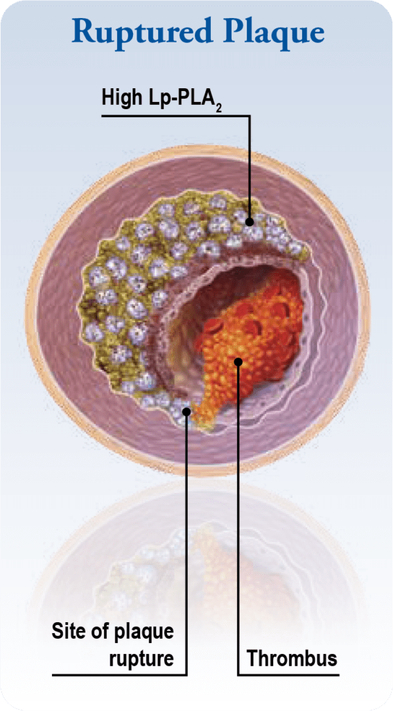 Lp-PLA2 (PLAC®) test for Chemistry Analyzers