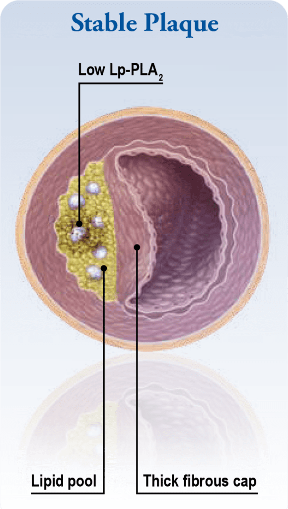 Lp-PLA2 (PLAC®) test for Chemistry Analyzers